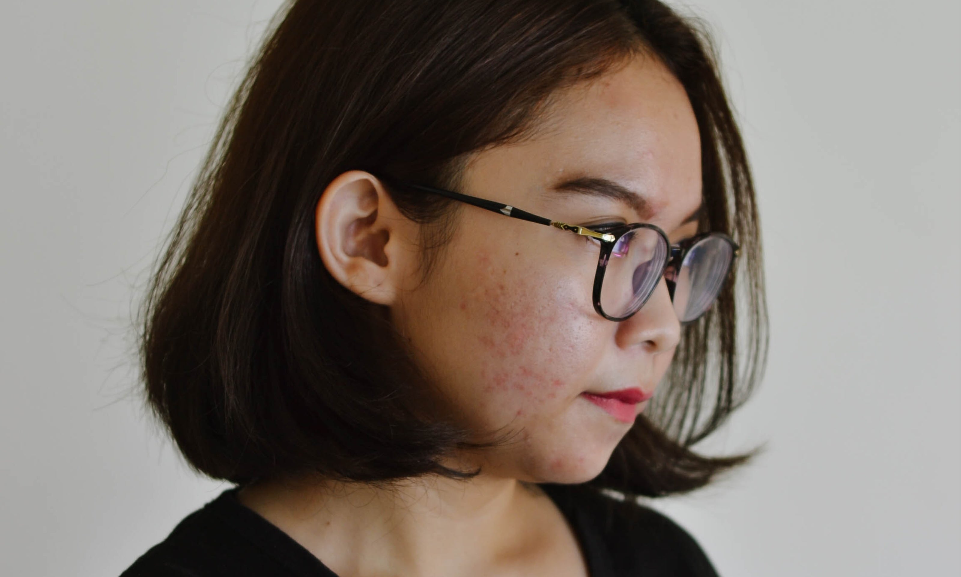 Acne? Fight Back! – Boutique Skin Envie