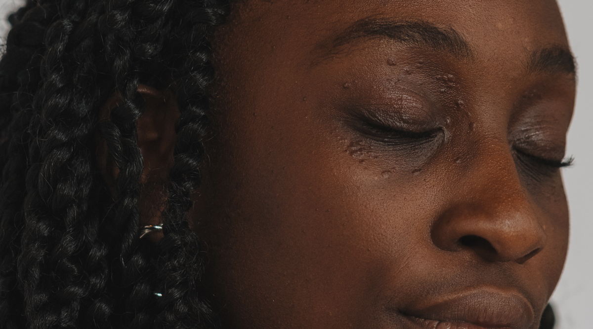 Understanding Milia: Causes, Prevention, and Treatment – Boutique Skin ...